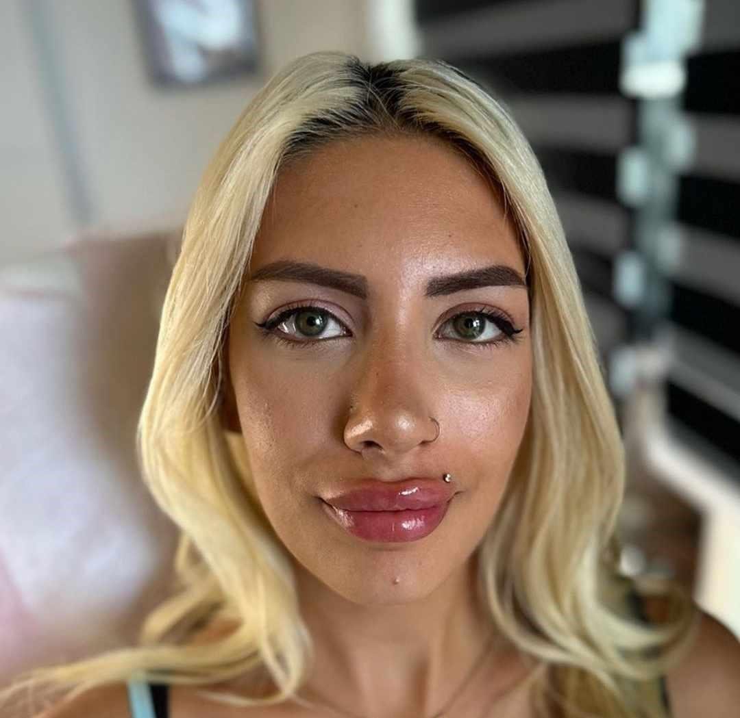 Turčija, vroča destinacija za lepotne operacije in presaditev las. In ...