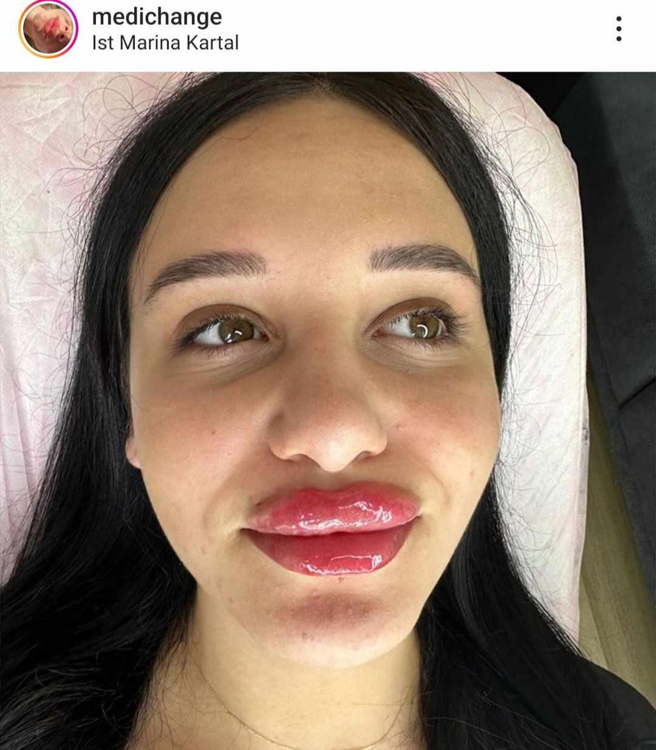 Turčija, vroča destinacija za lepotne operacije in presaditev las. In ...