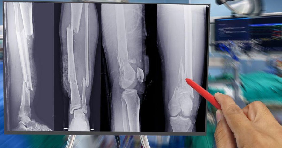 Pagetova bolezen – Kako poteka okrevanje? - Metropolitan.si