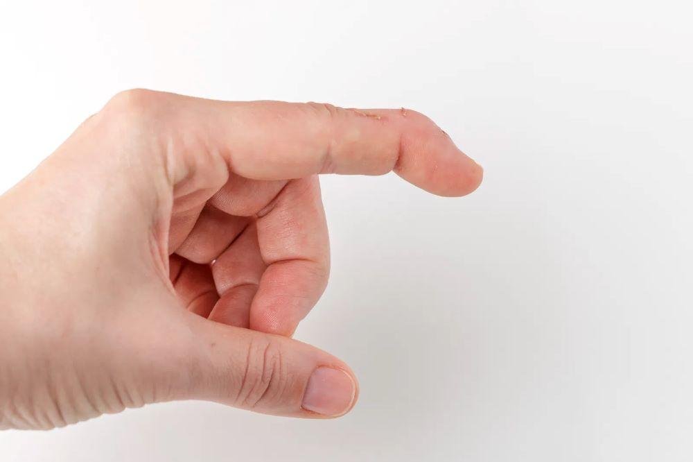Kladivasti prsti – Poškodba »Mallet finger« - Metropolitan.si